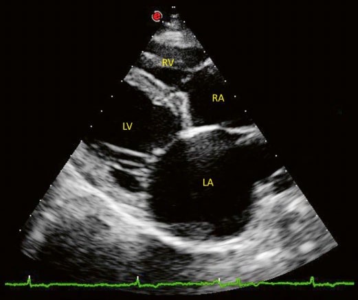Atrial cardiomyopathy in an adult Labrador | CHV Meaux