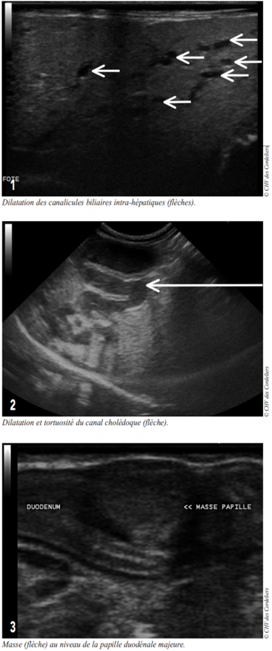 Obstruction biliaire extra-hépatique | CHV Cordeliers